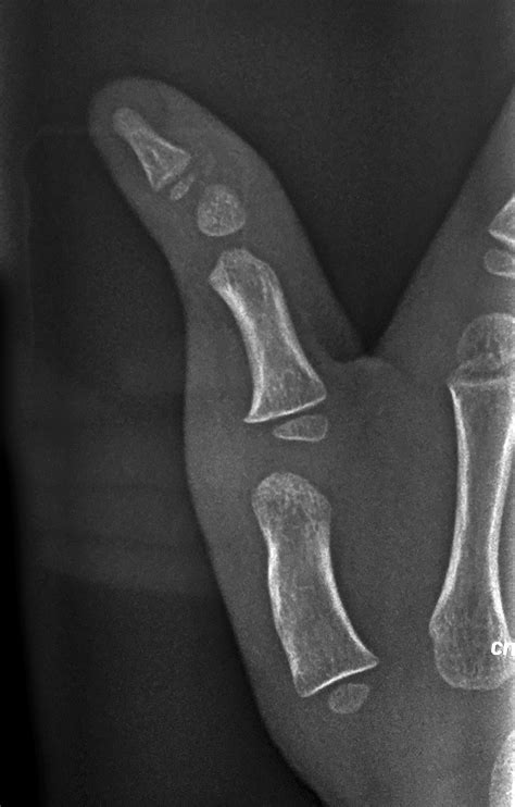 Thumb Deformity Congenital Hand And Arm Differences Washington