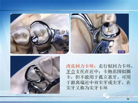 多图可摘局部义齿 卡环的种类 义齿技术 陕西嘉友科贸有限公司