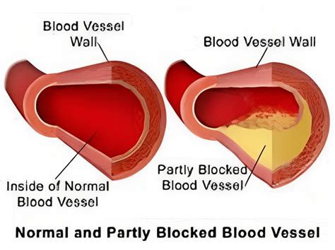 Atheroma The Silent Killer That You Need To Know About In 2023