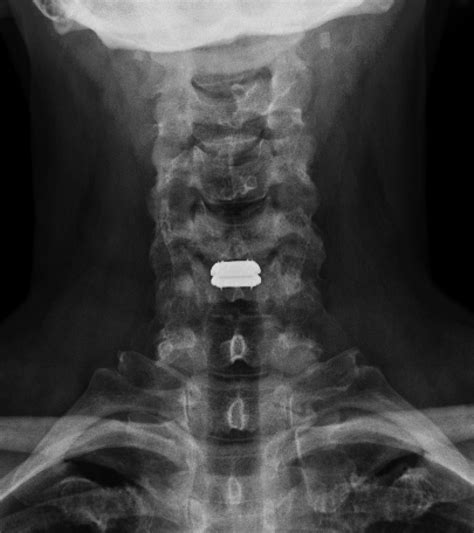 Cervical Disc Replacement — Matthew Mian Md