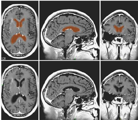 The 3d Segmentation Of Brain Ventricles From The Mean Image Note The Download Scientific