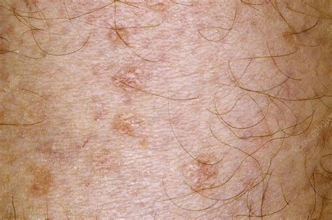 Skin Rash After Methotrexate Drug Stock Image C013 5883 Science Photo Library
