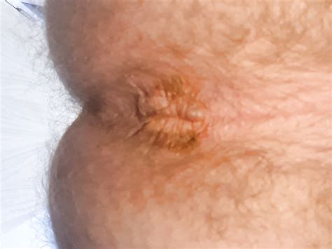 Nasty Diarrhea Squirt Image Thisvid Tube