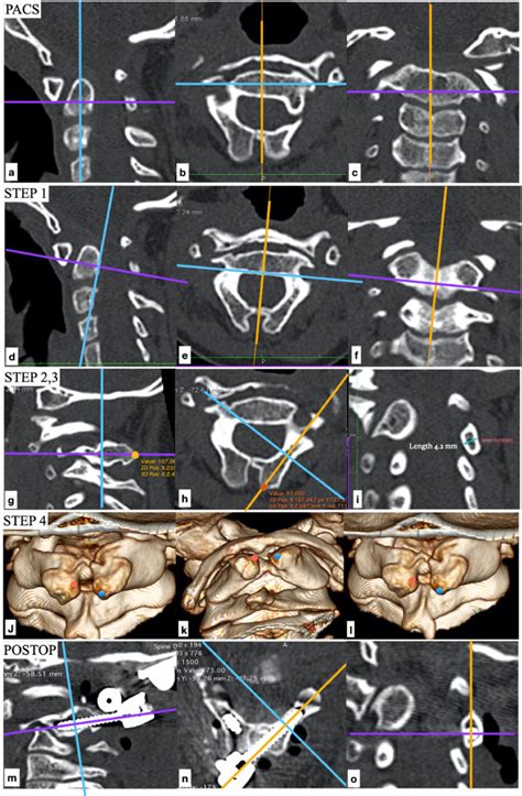 The Technique Of Using Three Dimensional And Multiplanar Reformatted Computed Tomography For