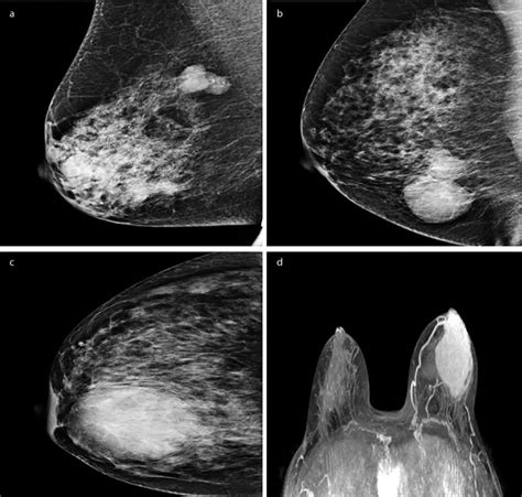 Phyllodes Tumor Of The Breast A Clinicopathological Evaluation Of 55 Cases Pmc