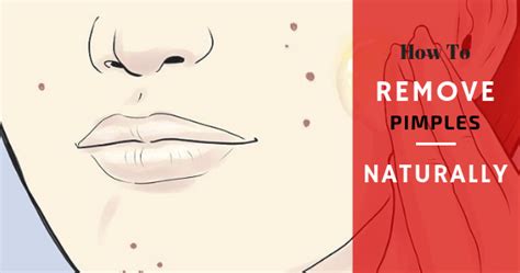 How To Remove Pimples Naturally