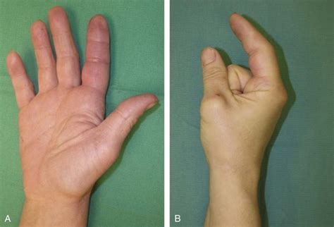 4 Drainage Of Purulent Flexor Tenosynovitis Plastic Surgery Key
