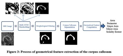 Fusion Of Features A Technique To Improve Autism Spectrum Disorder Detection Using Brain Mri