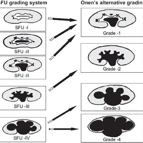 Comparison Of Sfu And Onens Hydronephrosis Grading System Ags Download Scientific Diagram