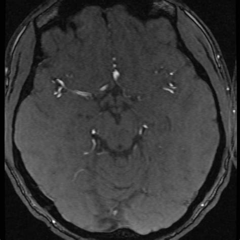 Azygos Anterior Cerebral Artery Radiopaedia 17059 16756 Axial Mra