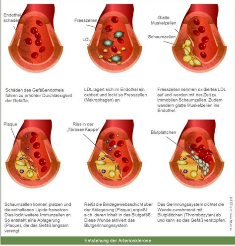 Pathogenese Der Arteriosklerose Schematisch Medizin Ernährung