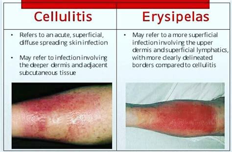 Erysipelas Vs Cellulitis Vs Impetigo