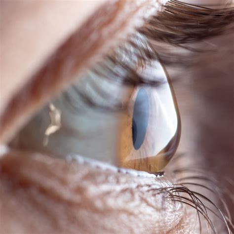 Thyroid Eye Disease Or Thyroid Orbitopathy Shekar Eye Hospital