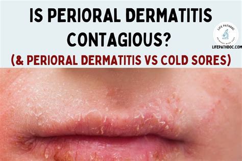 Is Perioral Dermatitis Contagious And Perioral Dermatitis Vs Herpes