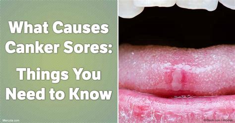 What Causes Canker Sores