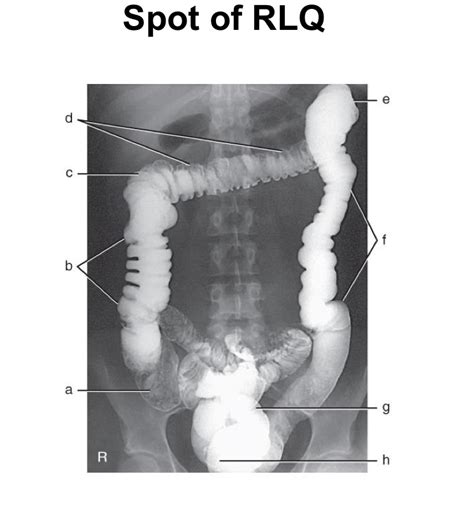 Spot Of Rlq Diagram Quizlet