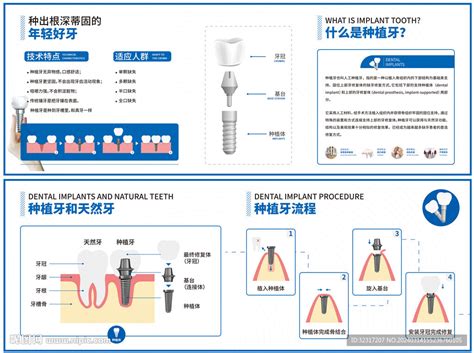 口腔种植牙科普展板挂画设计图 广告设计 广告设计 设计图库 昵图网