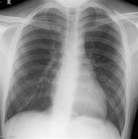 Denoising Experiments For Poisson Gaussian Corrupted Image A Image Download Scientific