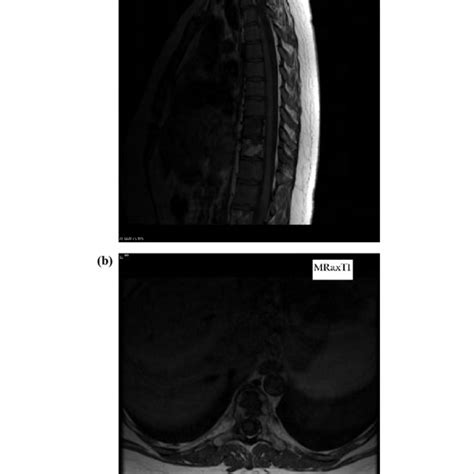 Tc 99m MDP Bone Scan Demonstrating Photopenic Defects At T9 And T10 Download Scientific Diagram