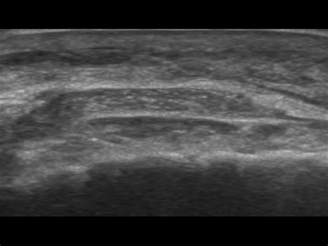 Musculoskeletal Joints And Tendons 66 Knee Case 6610 Bursa And