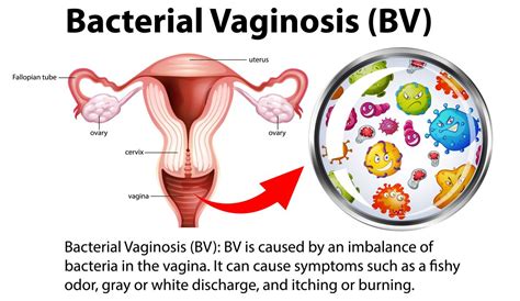 Bacterial Vaginosis Bv Causes Symptoms And Treatment