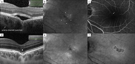 Fce Complicated With Cscr In A 46 Year Old Man Case 3 Os A Sd Oct