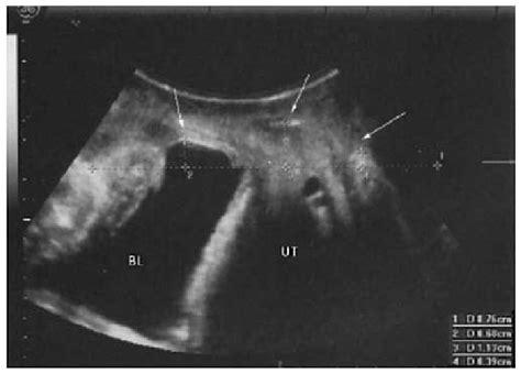 Grade Ii Cystocele And Grade Ii Prolapse Of Uterus Arrows Indicate