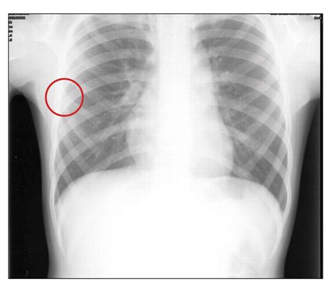Bifid Rib Symptoms At Minh Boser Blog