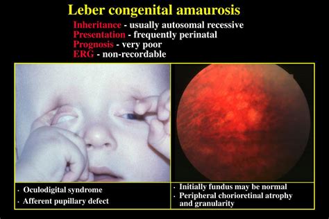 Ppt Hereditary Retinal Dystrophies Powerpoint Presentation Free Download Id 335032