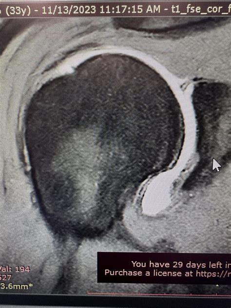 Mri Arthogram Right Shoulder Rorthopedics
