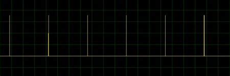 PWM Based Motor Speed Control Using Timer