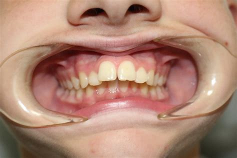 Fixing Buck Teeth Your Guide To Treatment Options And A Healthier
