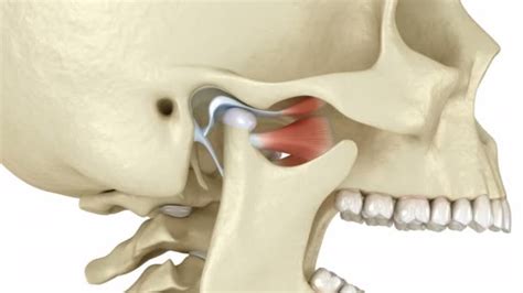 Temporomandibular Joints Dislocated Articular Disc Medically Accurate Animation — Stock Video