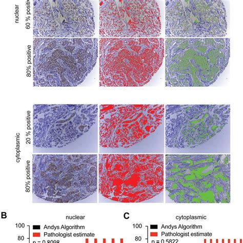Andys Dab Ihc Algorithm Can Be Used To Score Breast Cancer Tmas A