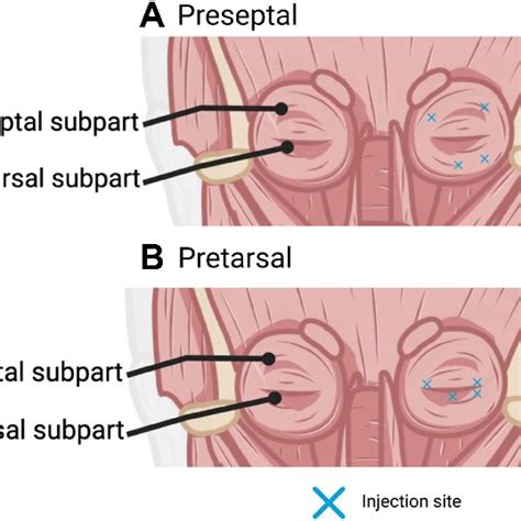 Botulinum Toxin Injection Techniques And Location Of Injection A