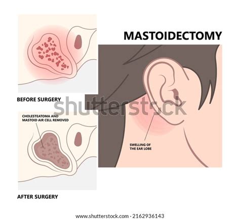 Mastoidectomy Types