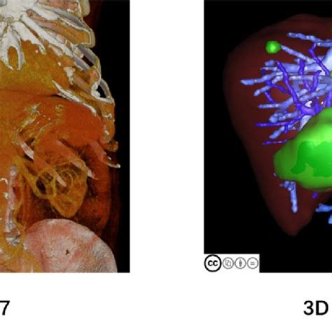 The Scans In Liver Tumor Segmentation Challenge Lits 2017 Dataset And