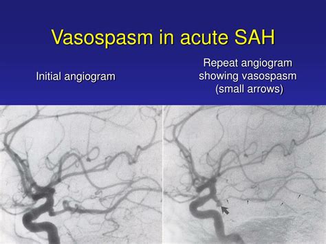 Ppt Critical Care Of The Patient With Acute Subarachnoid Hemorrhage