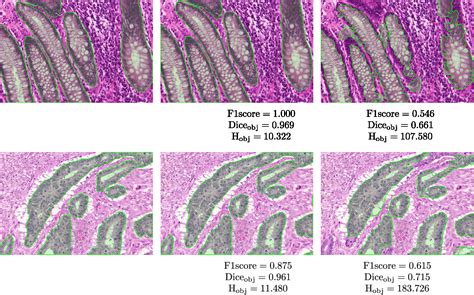 figure 1 from gland segmentation in colon histology images the glas