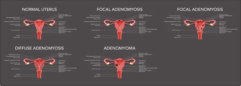 Adenomyosis의 세트 비문 텍스트와 인간의 해부학 여성 생식 아픈 시스템 기관 의료 위치 계획 자궁 자궁 경부 난소 나팔