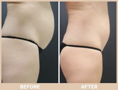 CoolShaping 冷冻溶脂消减脂肪细胞 减脂不反弹 New Beauty