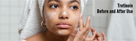 Tretinoin Before And After Use Okdermo