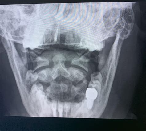 Odontoid Chefs Kiss Rradiology Odontoid Chefs Kiss Rradiology