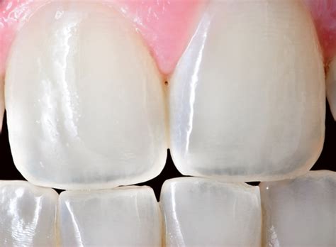 What To Do About Worn And Missing Enamel