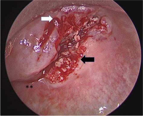 Pyriform Sinus Cancer