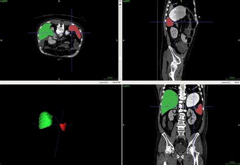 The Results Of Liver And Spleen Segmentation Red Liver And Green Download Scientific Diagram