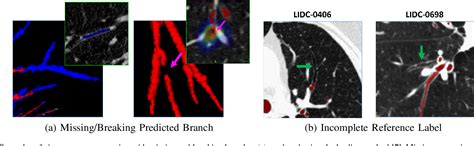 Accurate Airway Tree Segmentation In Ct Scans Via Anatomy Aware Multi Class Segmentation And