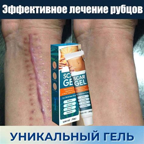 Гель для лечения угревой сыпи на лице мазь против ожогов и пигментных пятен на теле средство от