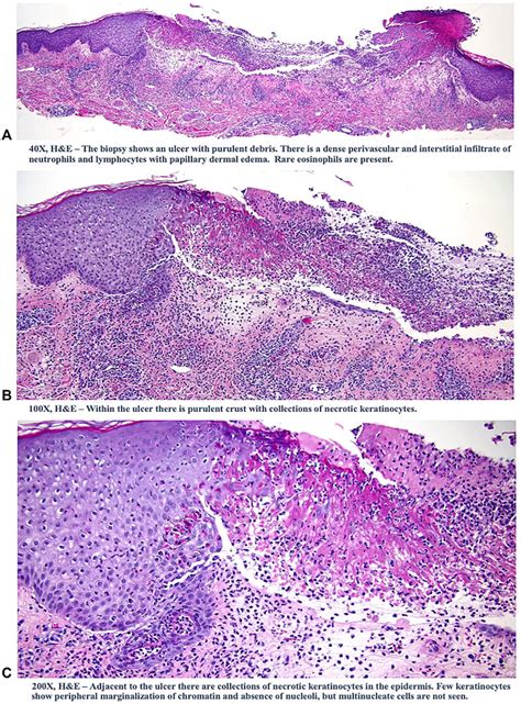 A The Biopsy Showed An Ulcer With Purulent Debris There Was Dense