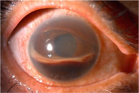 Candy Stripe Hyphema After Laser Peripheral Iridotomy Ophthalmology
